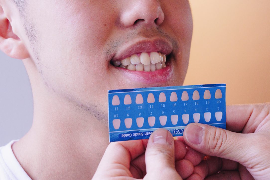 Teeth Whitening By Wellaholic Review: Up To 12 Shades Lighter Teeth In ...